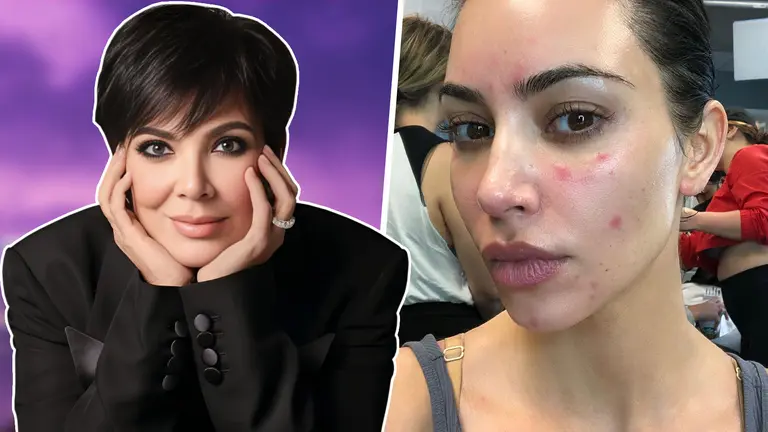 Enfermedades de las Kardashian: Kim y su psoriasis, Kris Jenner y su ...